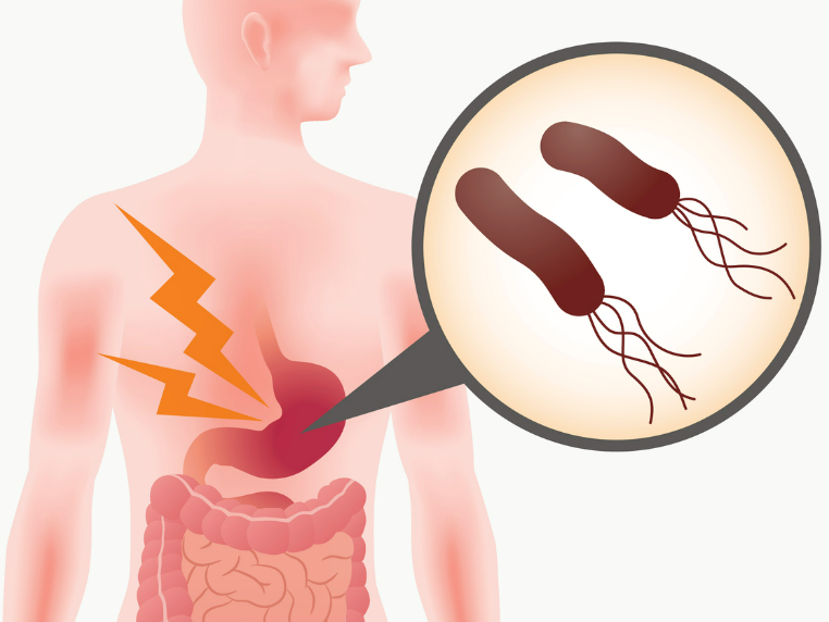 What is Helicobacter Pylori Bacteria?